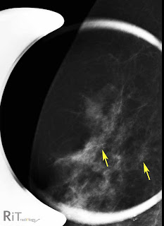 RiT radiology: Ductal Carcinoma in Situ