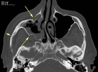 RiT radiology: Zygomaticomaxillary Complex (ZMC) Fracture