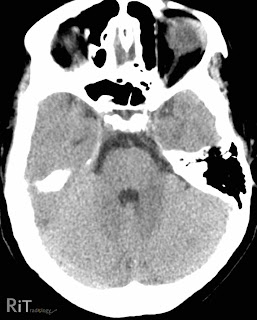 RiT radiology: Meningioma