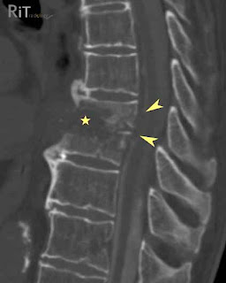 RiT radiology: Discitis-Osteomyelitis
