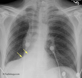 RiT radiology: Right Lower Lobe Atelectasis