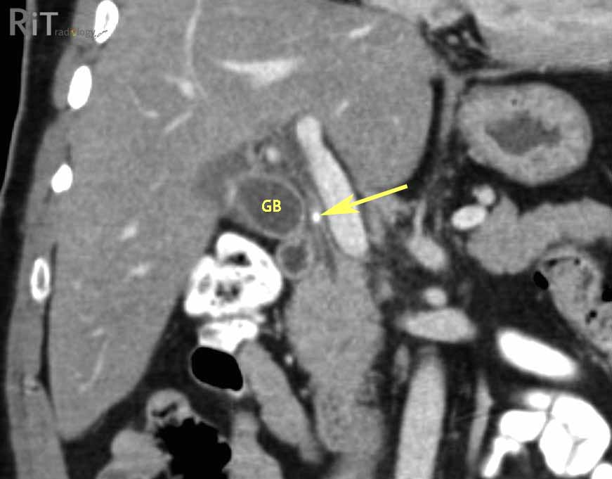 RiT radiology: Acute Cholecystitis