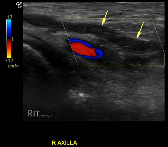 RiT radiology: Upper Extremity Deep Vein Thrombosis