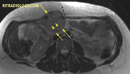 RiT radiology: Abdominal Wall Fibromatosis
