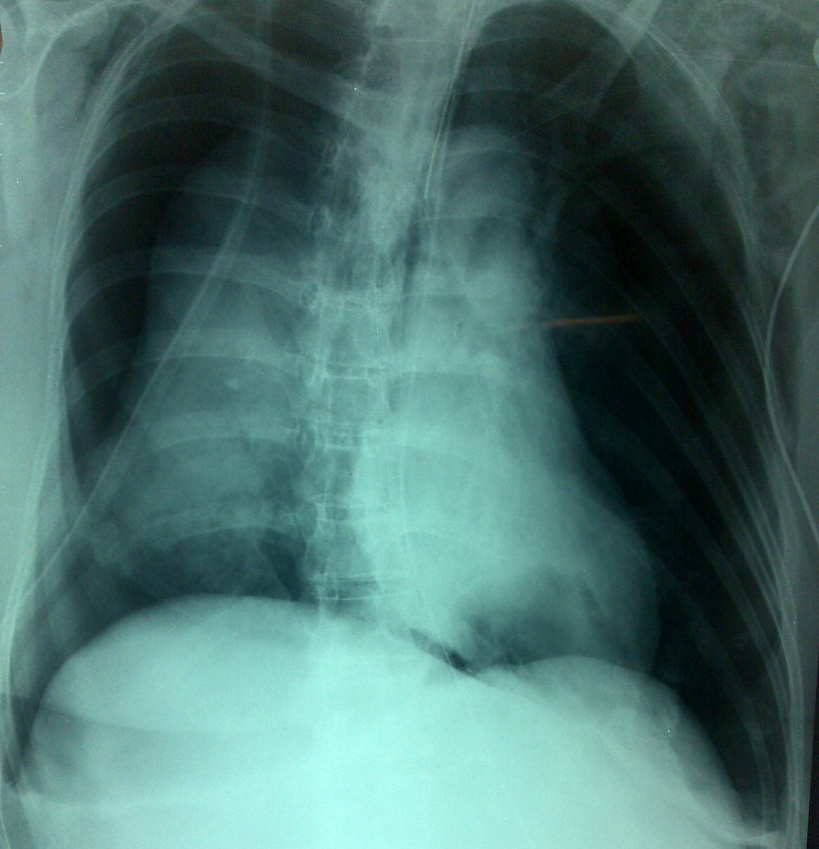 Endoscopia y Cirugía Digestiva: Neumotorax en la Unidad de Terapia ...