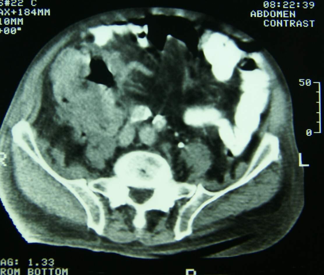 Endoscopia y Cirugía Digestiva: Otro aspecto tomografico de lesion ...