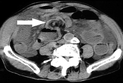 CT/USI: "Whirl Sign"