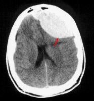 CT/USI: Brain Bleed