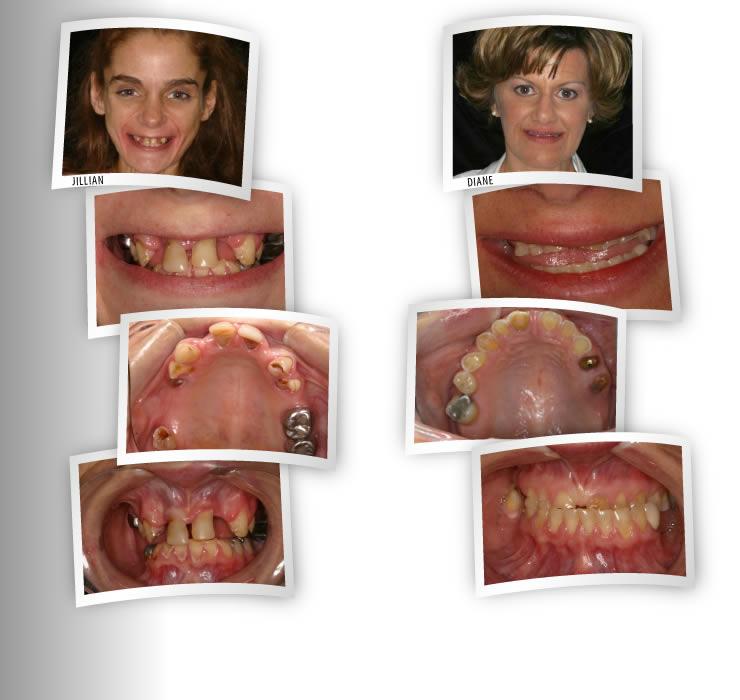 BULIMIA: How Bulimia Harms Teeth