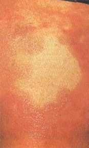 HANSENÍASE: Estudo epidemiológico publicado nos Anais Brasileiros de ...