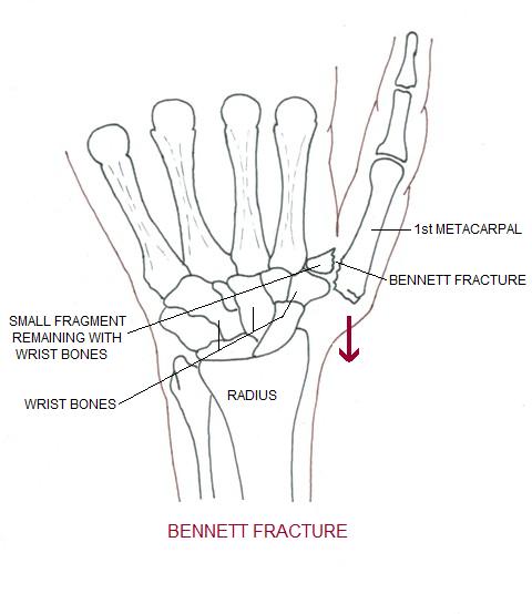 HiKaYaT PrinceSs: Bennet's Fracture