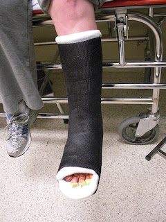High arch (Pes Cavus) and hammertoe surgery: Stitches out....new cast