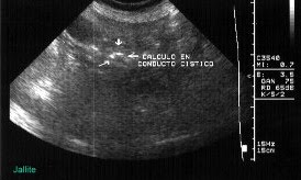 Calculo Conducto Cistico