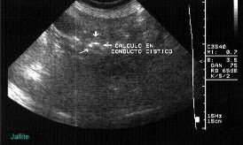 Calculo Conducto Cistico