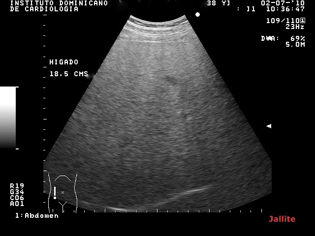 Hepatomegalia & Esteatosis Hepatica