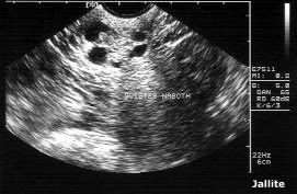 Ovarios Poliquisticos & Quistes Naboth