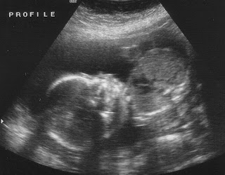 Baby Caroline: 19-week Ultrasound -- It's A....