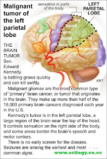 Science: Brain Tumor