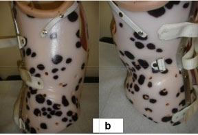 Brace technology: derotation brace