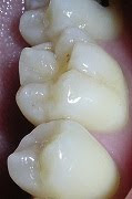 Infiltration Therapy for Minor Tooth Decay