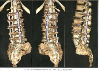 Forca Positiva : Operação da Coluna Lombar L-1 a L5