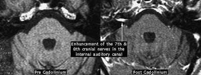 CT/MRI: Ramsay Hunt Syndrome