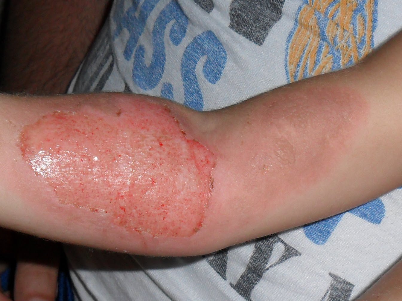 The Howard Family: Caroline's Arm