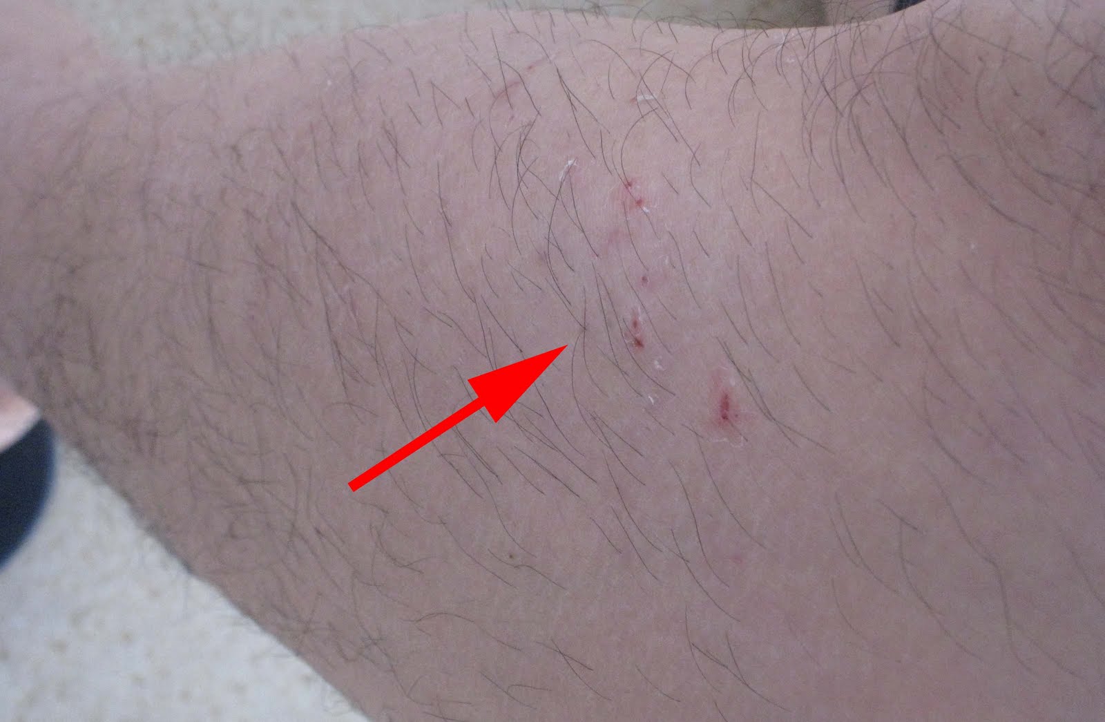 Seeing the World: Uganda - My Injury Report