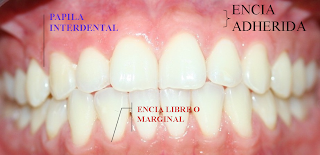 Periodoncia: UNIDAD I: CARACTERISTICAS DEL PARODONTO NORMAL