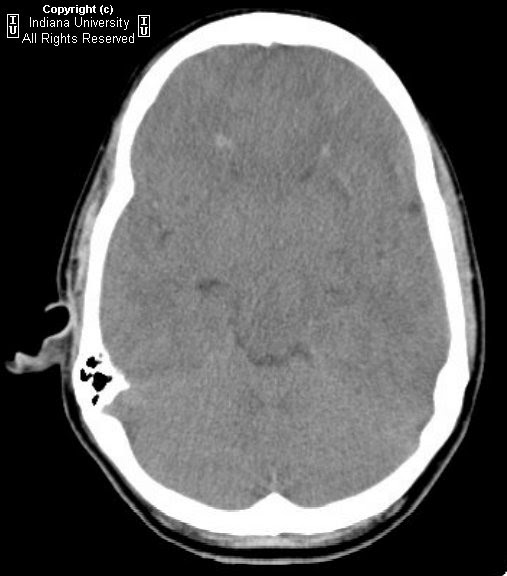 Neuroradiology On the Net: Diffuse axonal injury (DAI)