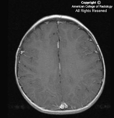Neuroradiology On the Net: Acute disseminated encephalomyelitis (ADEM)