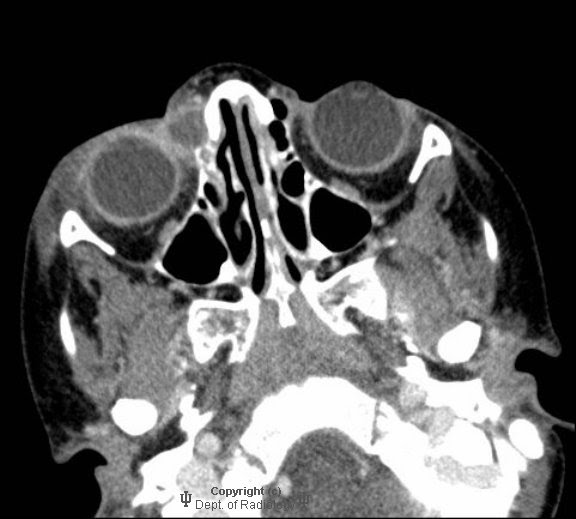 Neuroradiology On the Net: Dacryocystitis