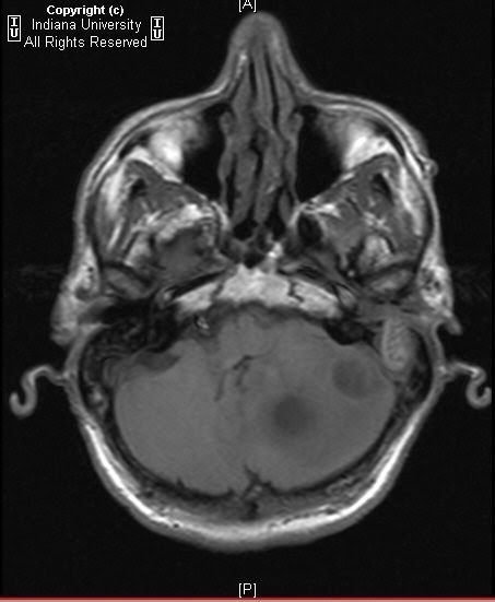 Neuroradiology On the Net: Mastoiditis with cerebellar abscesses