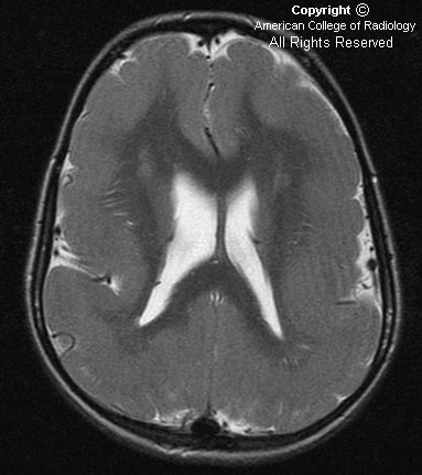 Neuroradiology On the Net: Pachygyria