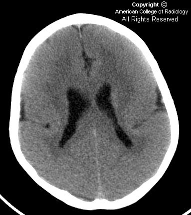 Neuroradiology On the Net: Pachygyria