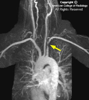 Subclavian steal syndrome; Brachial-Basilar Insufficiency Syndrome ...