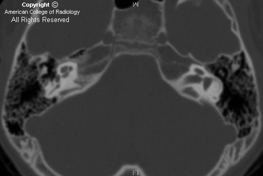 Holoprosencephaly: Mondini malformation