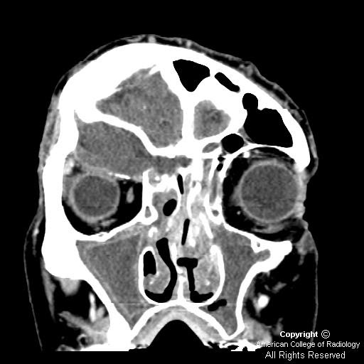 Neuroradiology On the Net: Frontal sinus mucocele