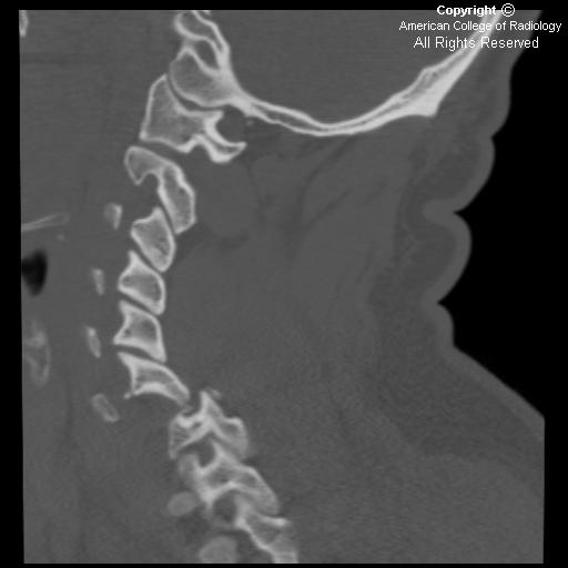 Neuroradiology On the Net: Bilateral jumped facets with spinal cord ...