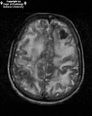 Neuroradiology On the Net: Lupus cerebritis