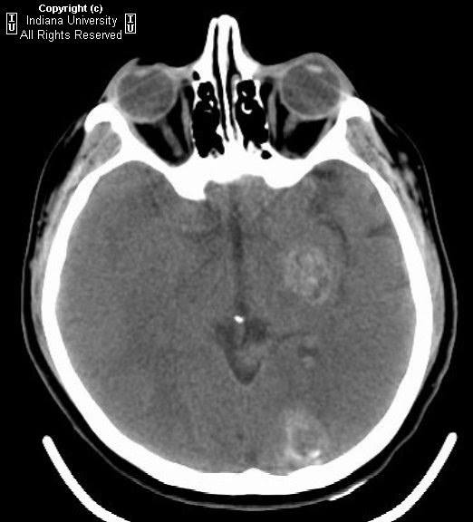 Neuroradiology On the Net: Multiple cavernous malformations (AKA ...