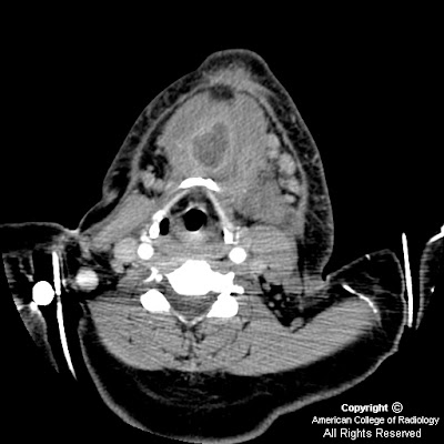 Neuroradiology On the Net: Floor of the mouth abscess causing early ...