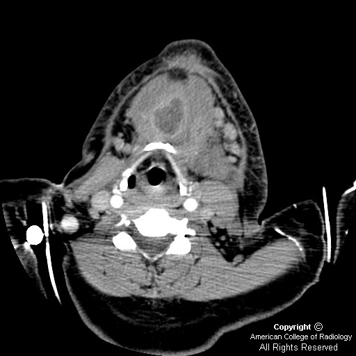 Neuroradiology On the Net: Floor of the mouth abscess causing early ...