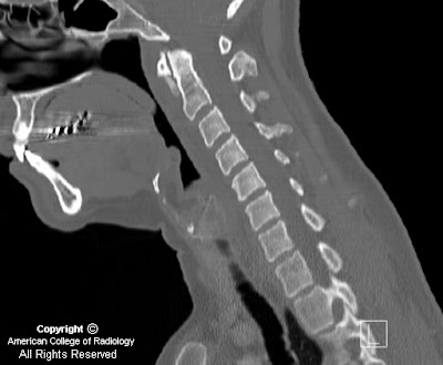 Neuroradiology On the Net: Acute calcific tendonitis of the longus ...