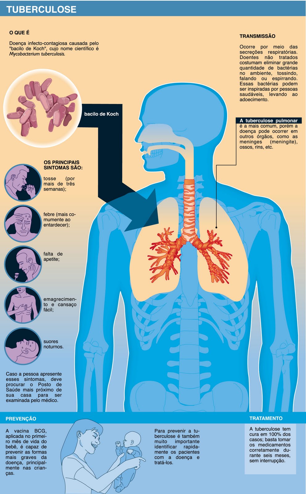 INFOGRÁFICO: Tuberculose (Seminários 2ª Unidade - Grupo F) ~ Medicina UnP