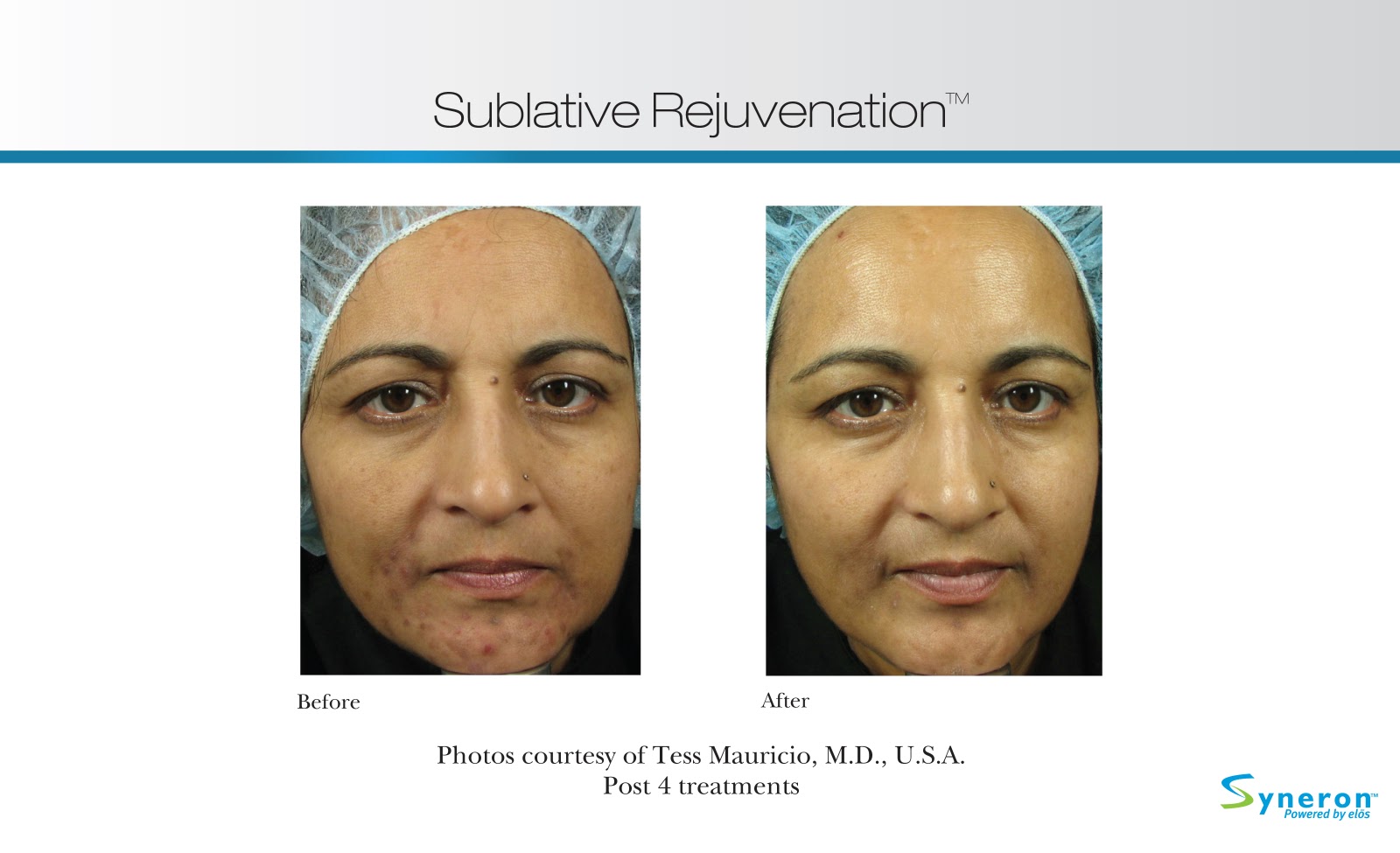 Body Image Optimization: eMatrix Before and After