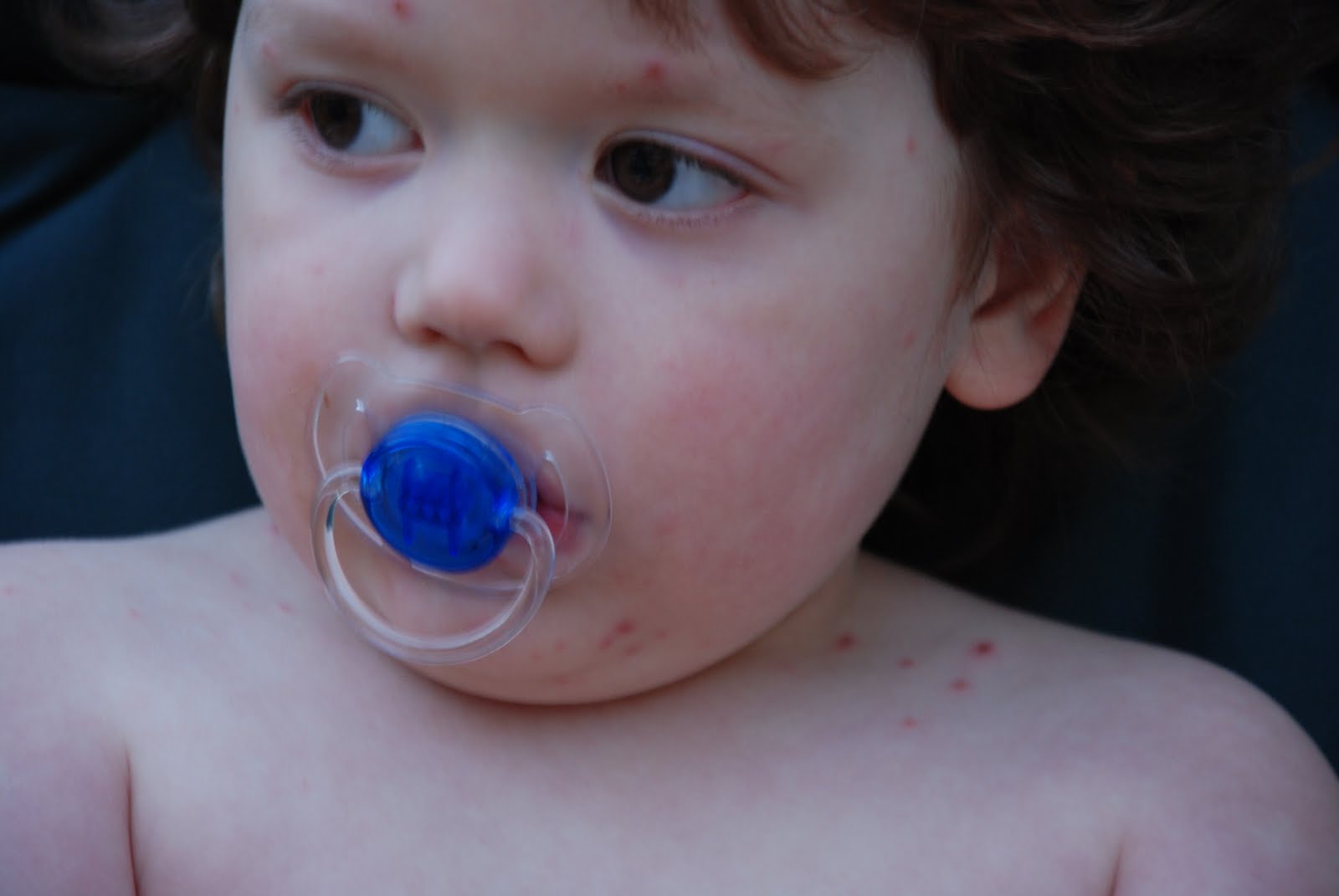 Homemade Serenity: A Pox on our House