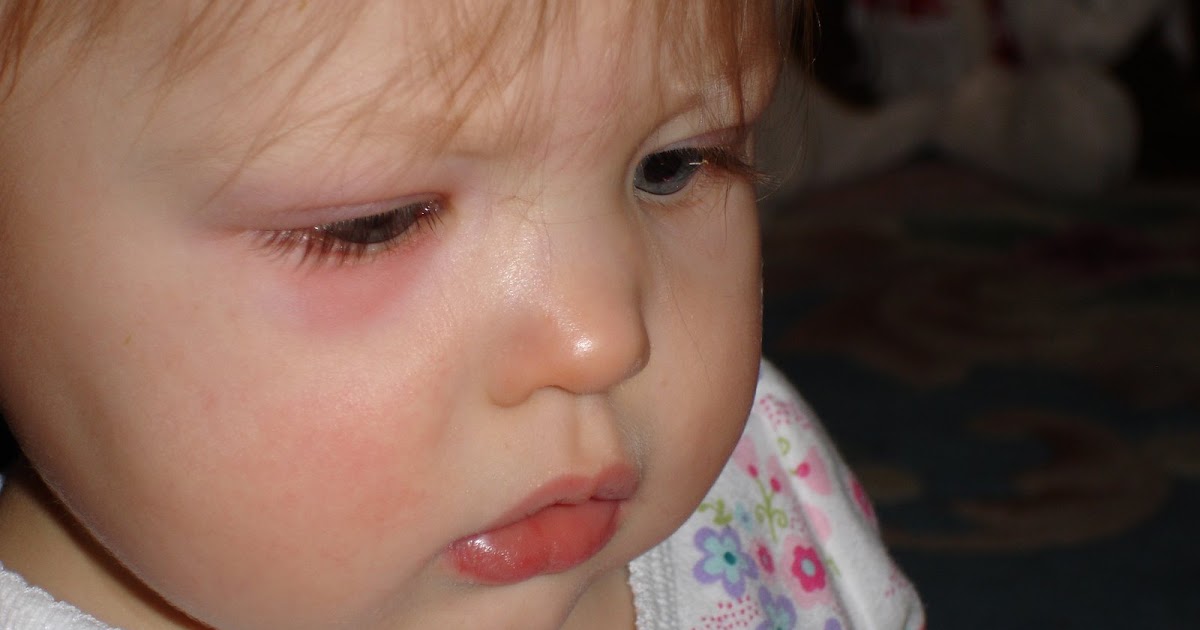 The Sink Family: periorbital cellulitis...