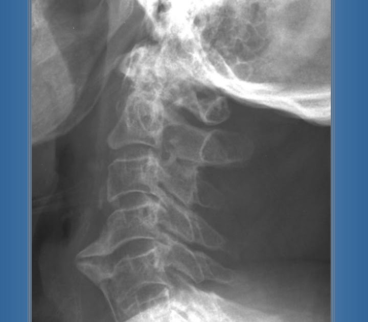 Radiology Links: Imagem de Caso - Osteofito Cervical