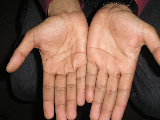 Vitiligo Skin disorder treatment: Vitiligo Recovery Advice in Initial Stage
